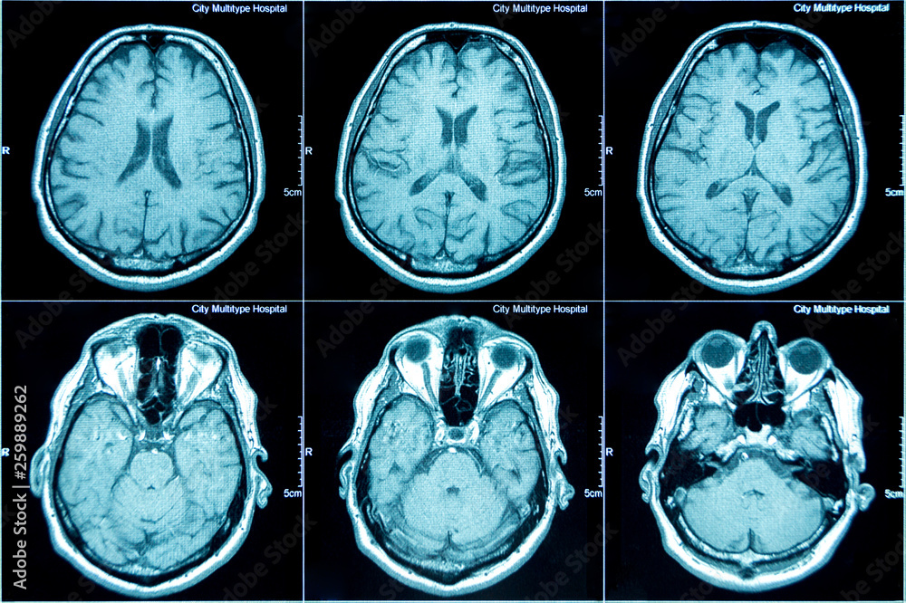 MRI scan of the brain Stock Photo | Adobe Stock