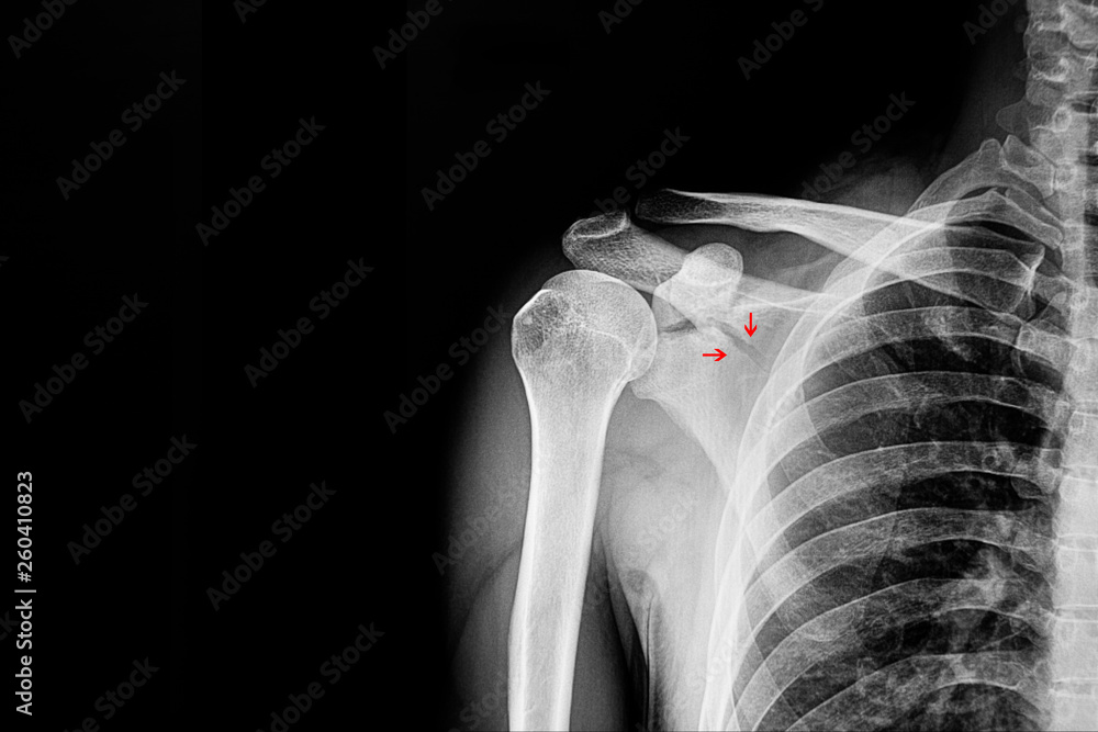 chest xray of the patient with fracture scapular Stock Photo | Adobe Stock