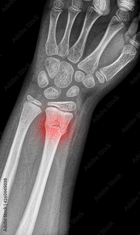 X-ray of a consolidating fracture of a radial bone of the child Stock ...