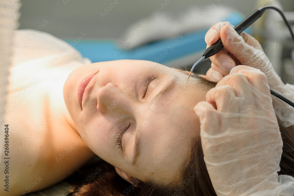 Medical treatment removal of birthmark from female patient's face ...