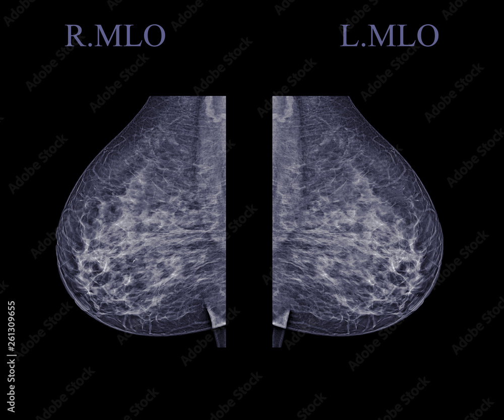 X-ray Digital Mammogram or mammography both side of the breast MLO view ...