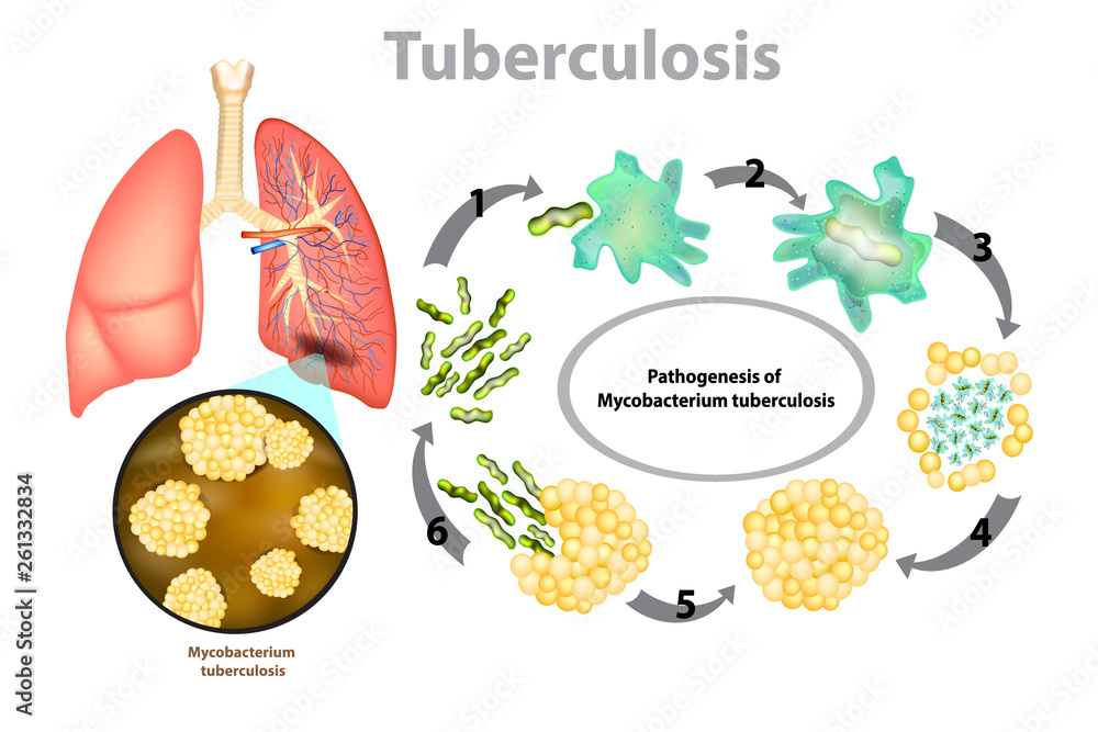 Tuberculosis (TB). Progression of pulmonary tuberculosis ...