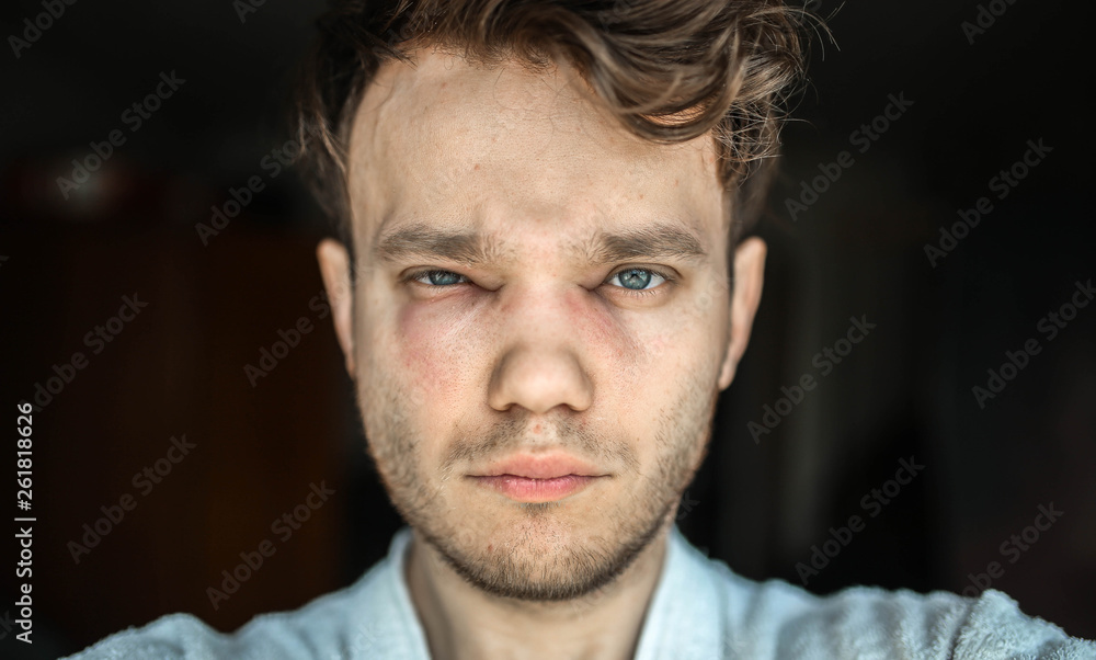 Real allergic reaction in a man face, eyes, nose. Dangerous disease ...