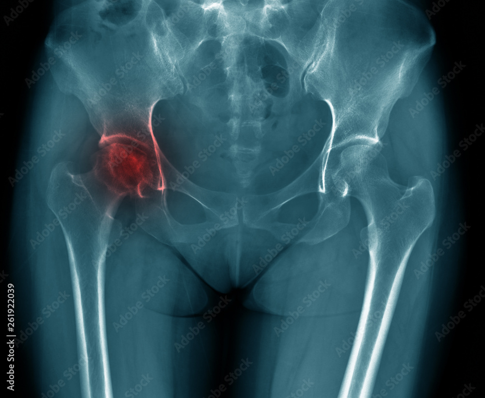 x-ray image of old woman show degenerative change of hip joint, hip ...