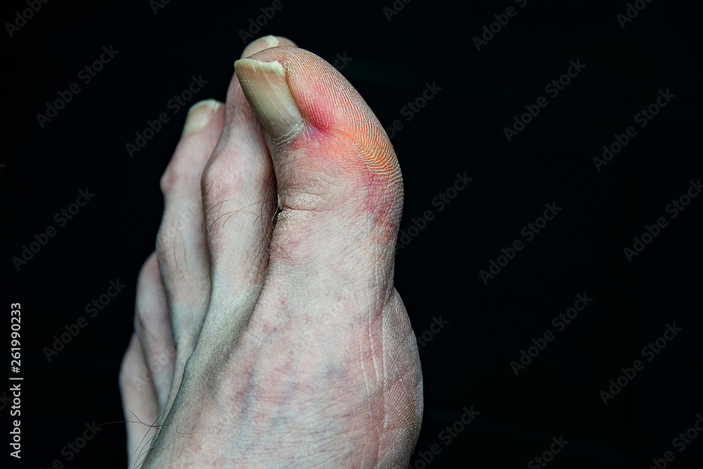Foto de Stock Big toe with dry skin and slightly inflamed knuckle joint ...