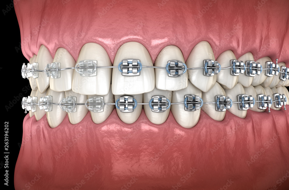 Teeth with metal and Clear braces in gums. Medically accurate dental 3D ...