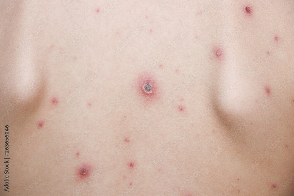 Foto de Stock Chicken pox rash on young boy body.Chickenpox is an ...