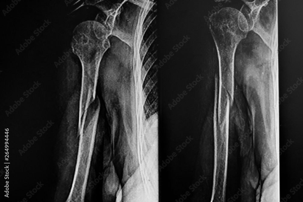 X- Ray of Right humerus bone fracture Stock Photo | Adobe Stock