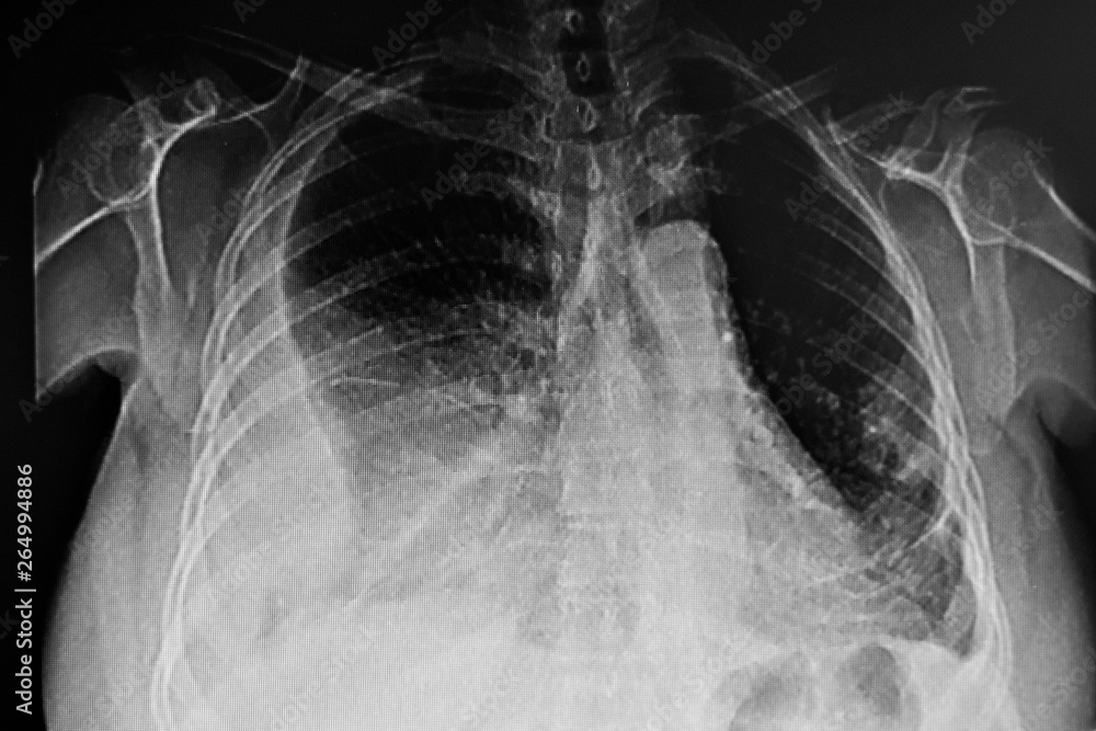 Chest X-Ray of a male patient with right pleural effusion and pneumonia Stock Photo | Adobe Stock