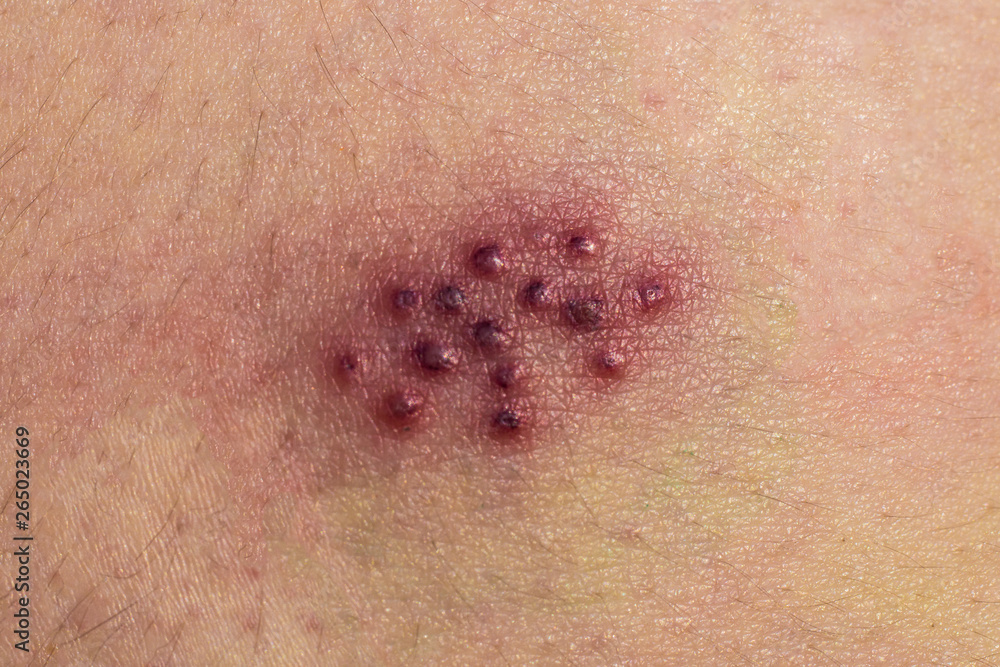 Virus on the body. Rash of Shingles on the skin. Bright red blisters of ...