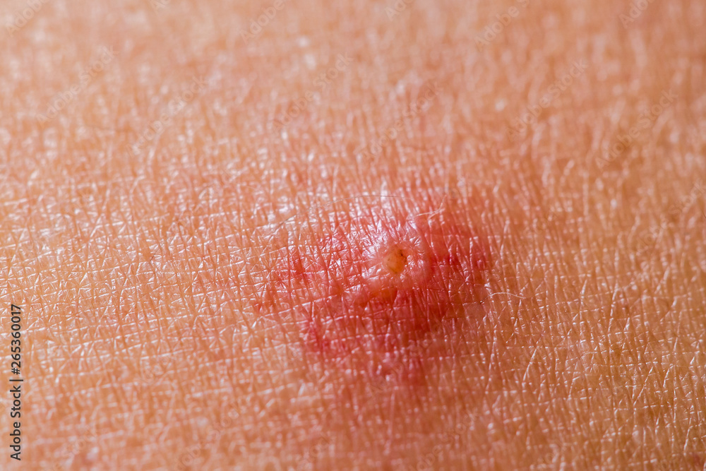 Wound infection on the skin, Skin lesions, Impetigo, Ecthyma, Pressure ...