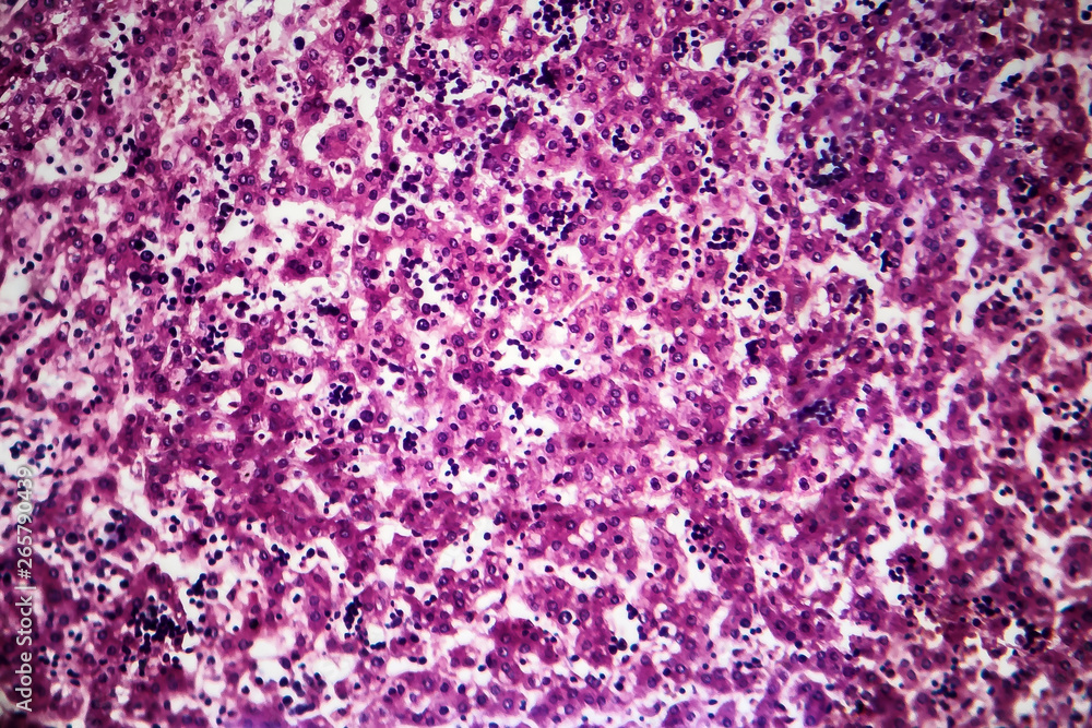 Ilustración de Stock Histopathology of chronic active hepatitis, light ...