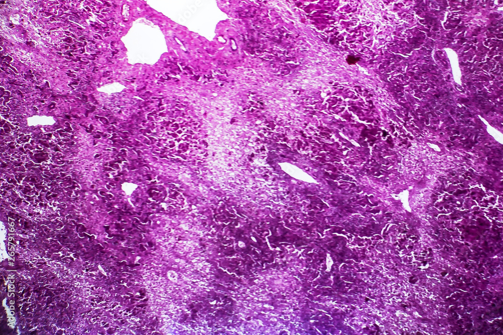 Histopathology of subacute severe hepatitis, light micrograph, photo ...