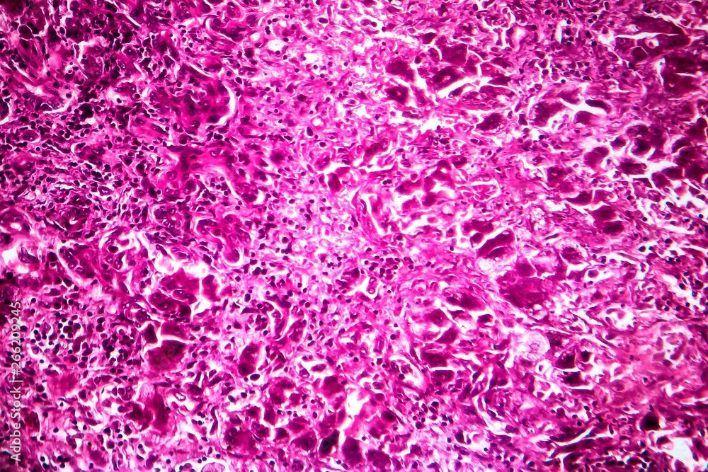 Histopathology of subacute severe hepatitis, light micrograph, photo ...