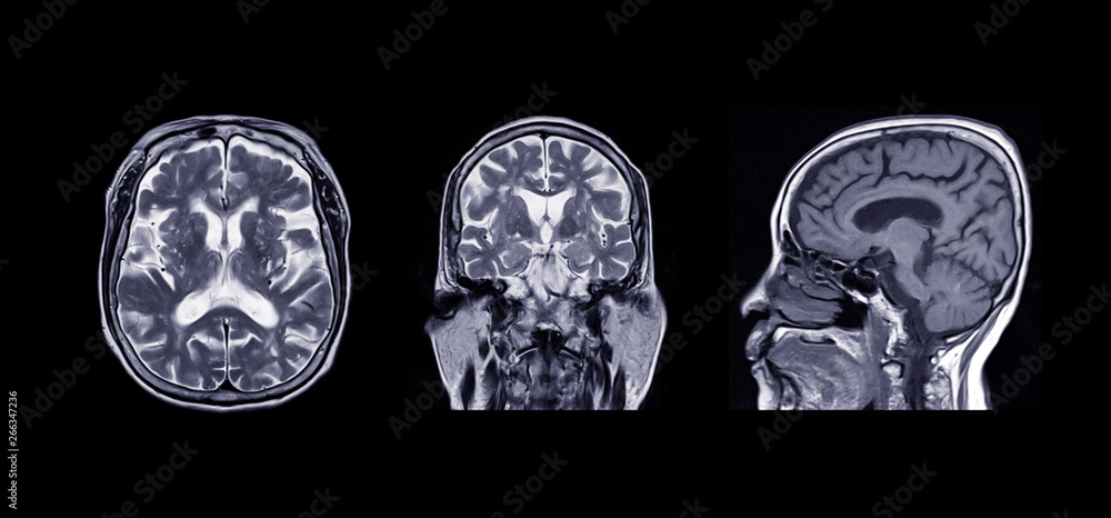 Comparison MRI of the brain Axial, Coronal , sagittal plane for detect ...