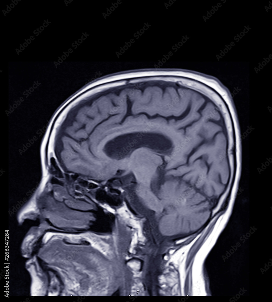 Comparison MRI of the brain sagittal plane for detect a variety of ...