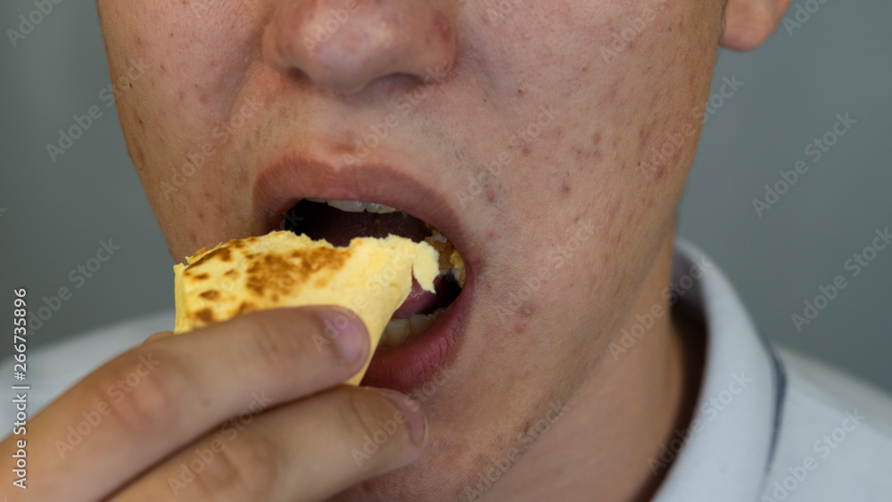 Man with pimples and acne on the face is eating unhealthy food, Macro ...
