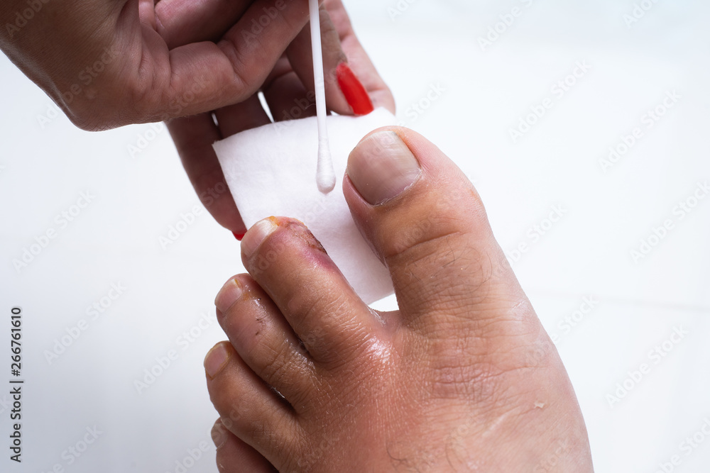 Finger on the leg. Purulent wound on the leg. Eczema. Dermatitis ...