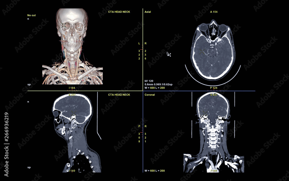 CTA brain comparison Axial , Coronal and Sagittal view 2D and 3D ... CTA brain comparison Axial , Coronal and Sagittal view 2D and 3D ...