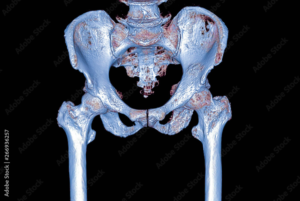 Photo Stock CT Scan of pelvic bone with both hip joint 3D rendering ...