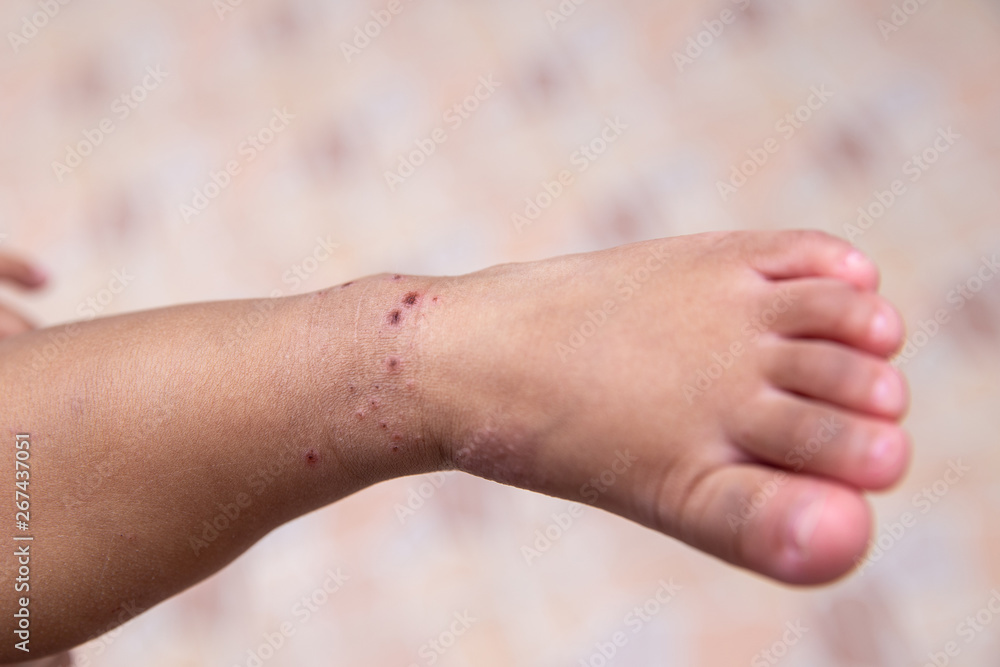 Boy with symptoms hand, foot and mouth disease . children " HFMD " with ...