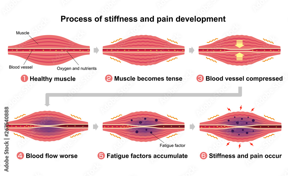 Process of muscle's stiffness and pain illustration ( 6 steps ) Stock ...