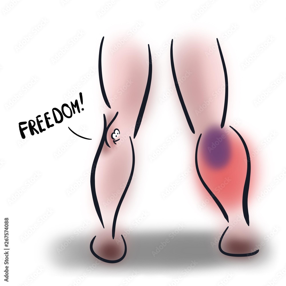 Baker cyst rupture and hematoma Stock Illustration | Adobe Stock