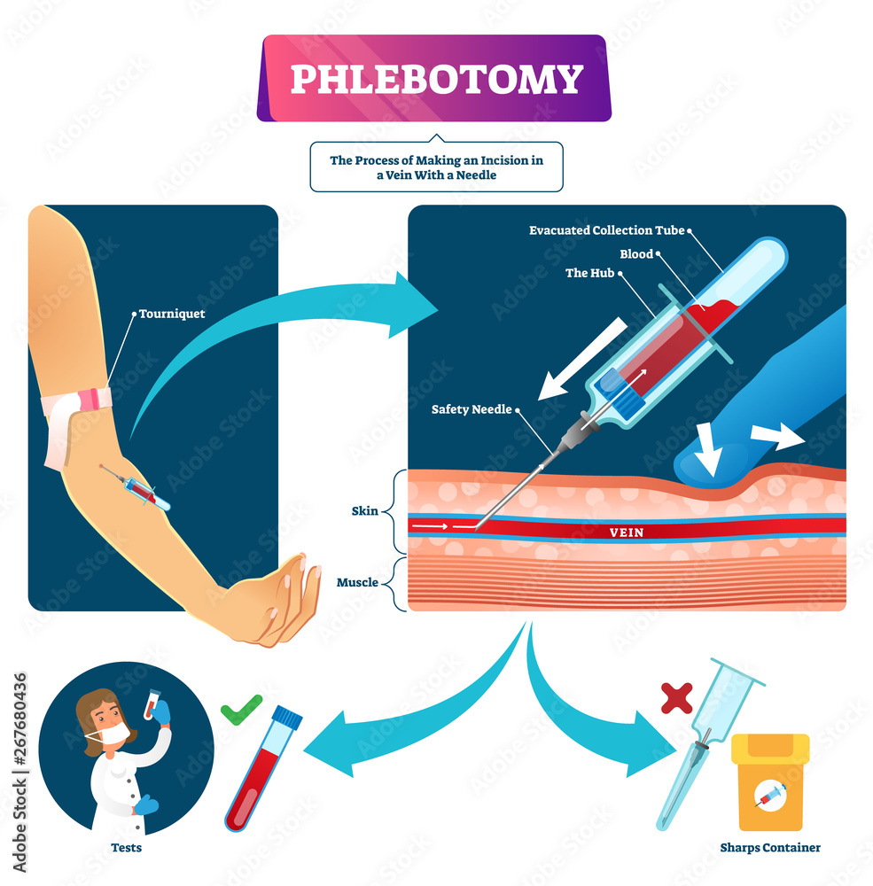 Phlebotomy vector illustration. Labeled veins blood samples process ...