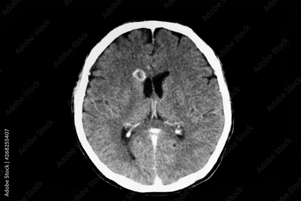 CT scan of a patient with brain abscess Stock Photo | Adobe Stock