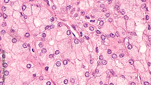 Microscopic image of an acinic cell carcinoma, a rare cancer of ...