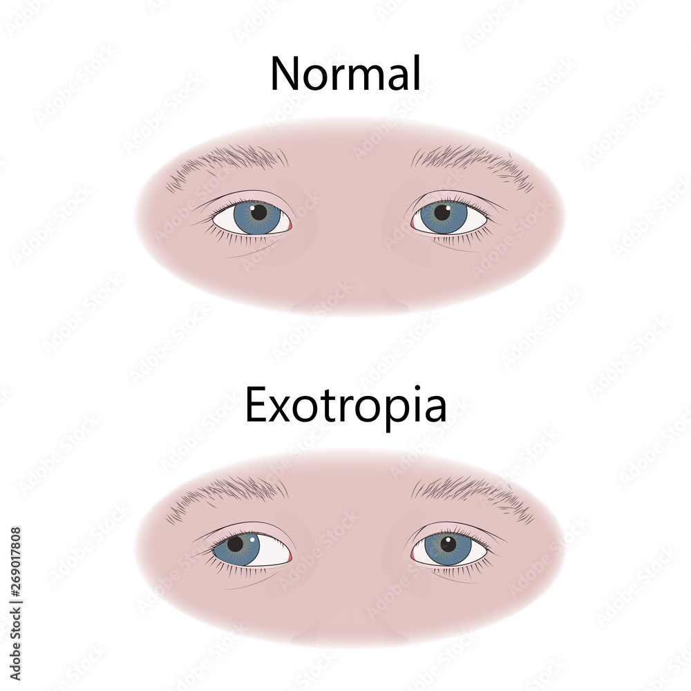 Strabismus in infants, child, kid. Wall-eyed, exotropia, outward eyes ...