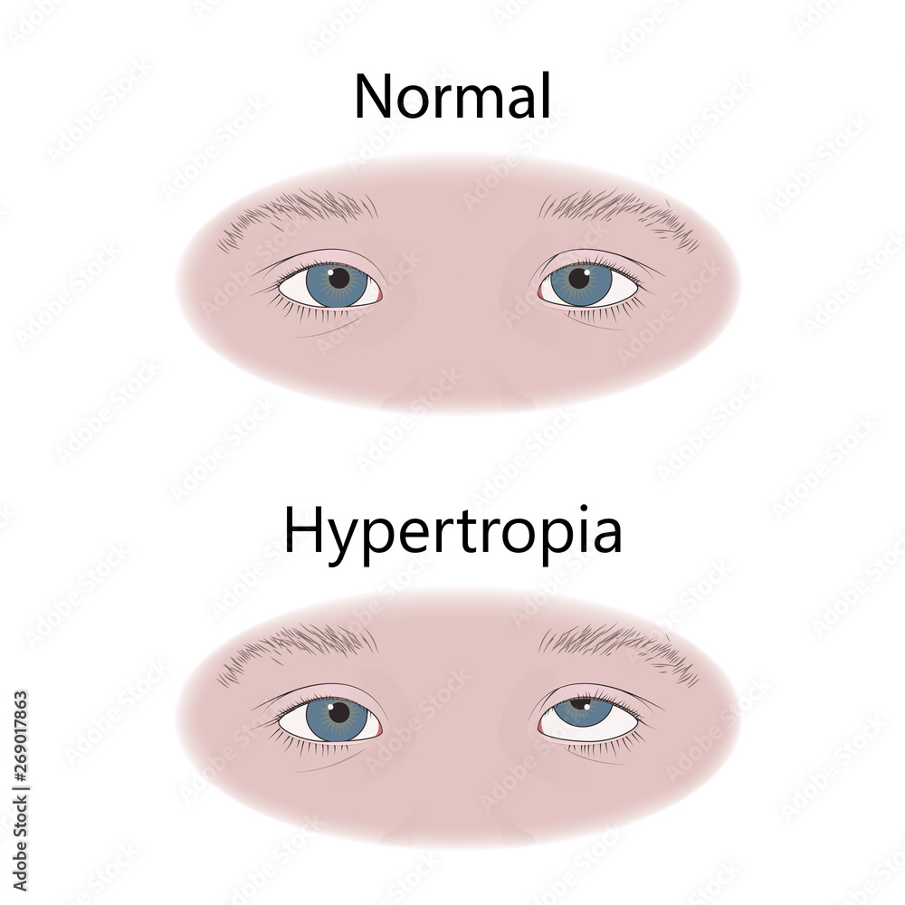 Strabismus in infants, child, kid. Hypertropia, upward eyes. Comparison ...