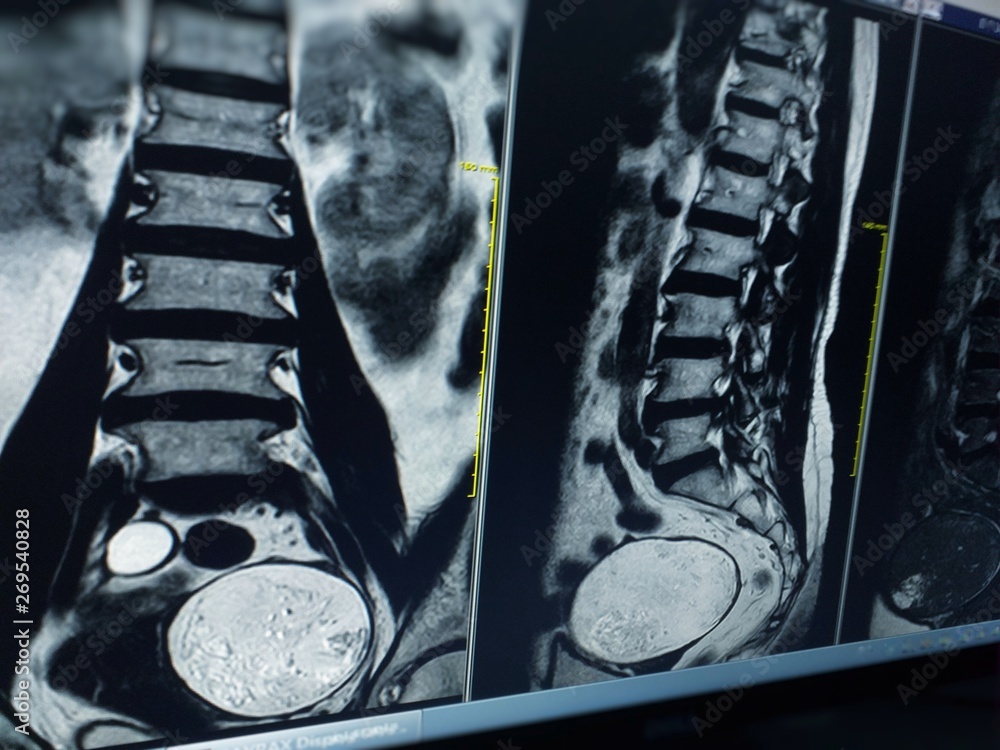 X-ray image Two views MRI lumbar spine showing Herniated nucleus ...