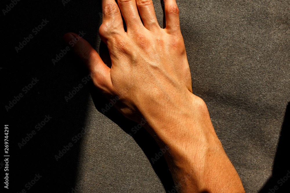 Maffucci syndrome of the hand with tumor of bone and soft tissue ...