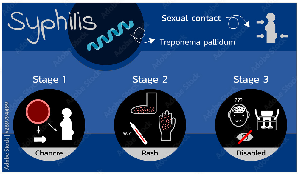 Stages of Syphilis disease , infographic vector 素材庫向量圖 | Adobe Stock