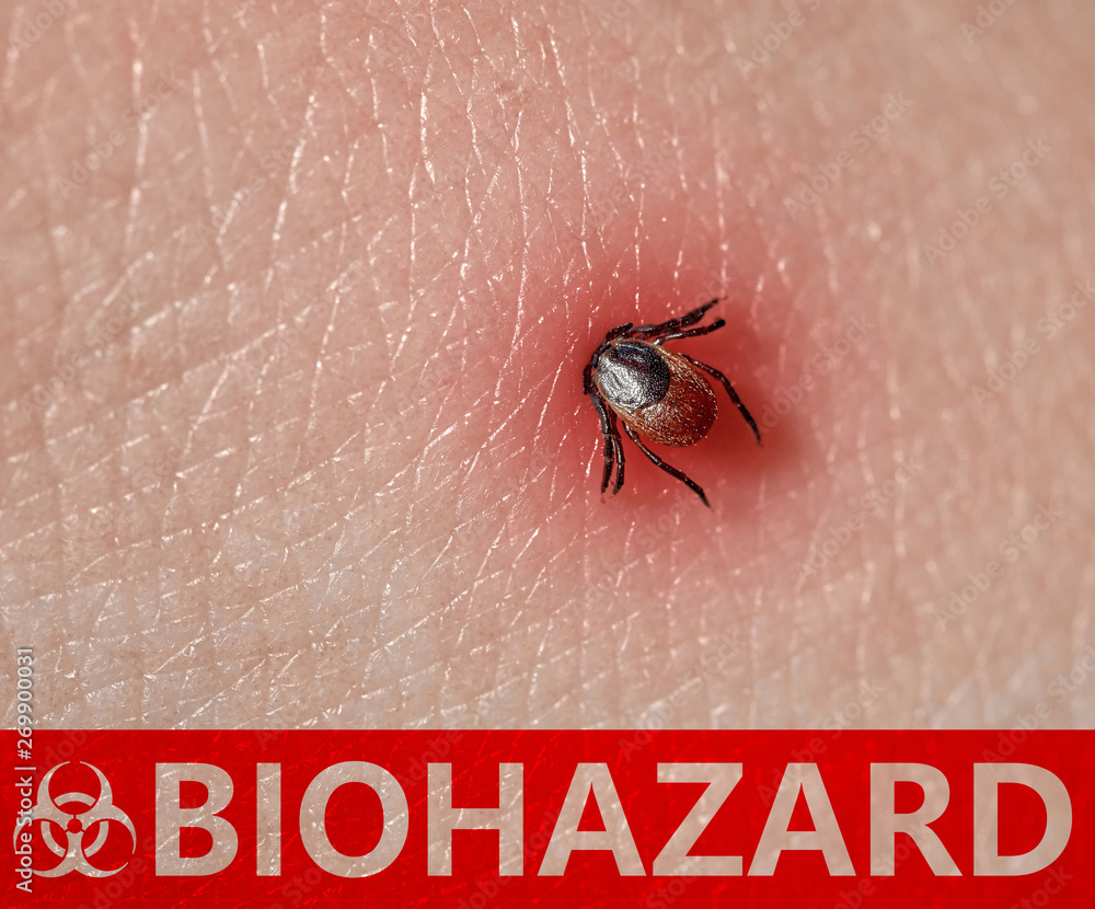 Sucking tick Macro photo on human skin. Ixodes ricinus. Bloated ...