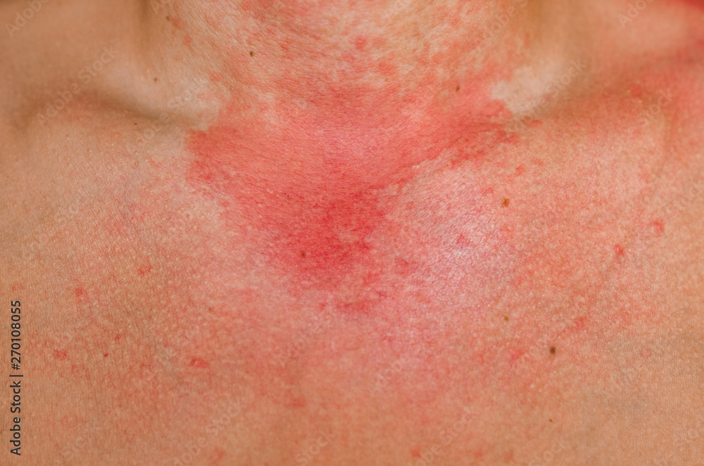 Allergic skin reaction on the man neck and face - red rash Stock Photo ...