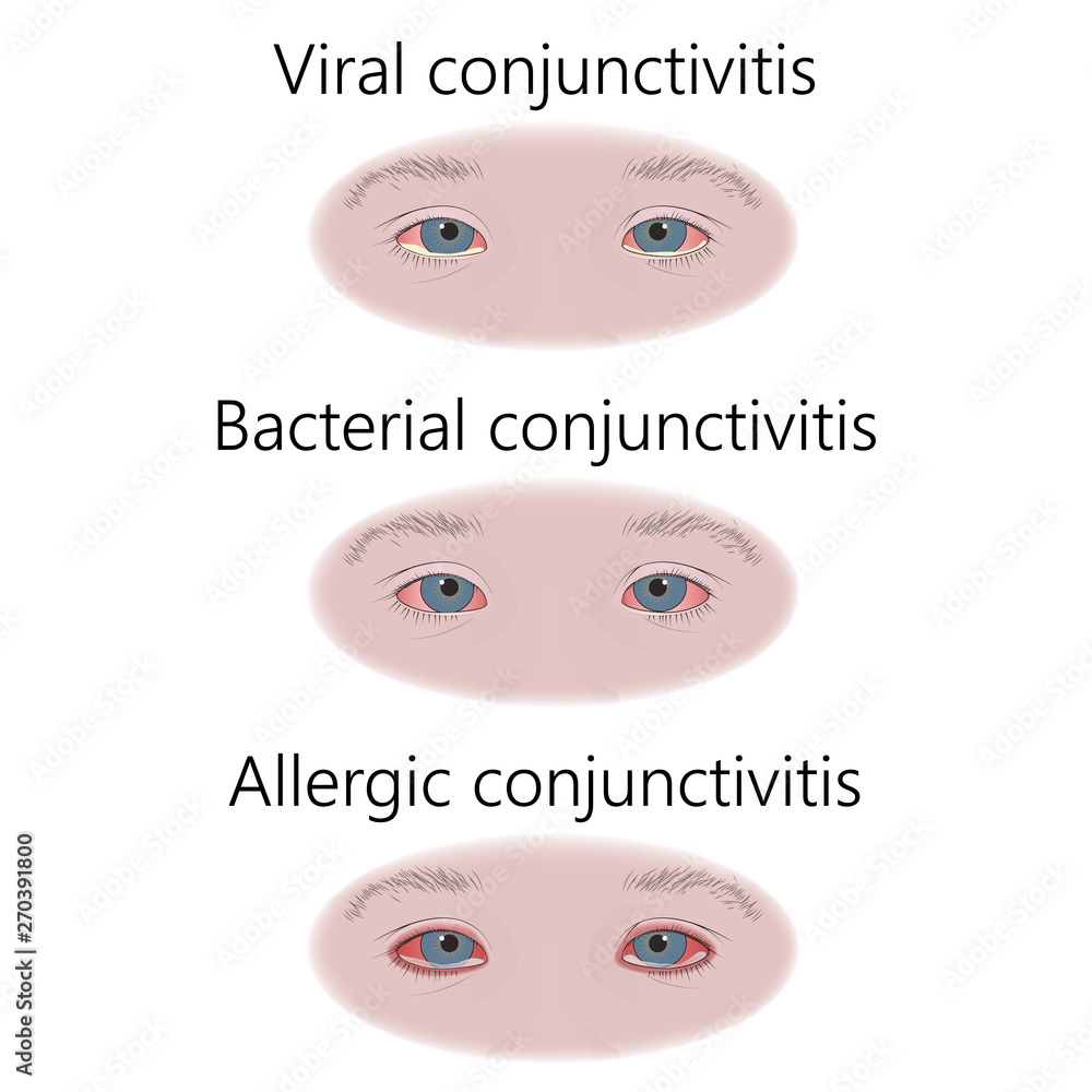 Types of conjunctivitis. Allergic. Allergy. Viral. Virus. Bacterial ...