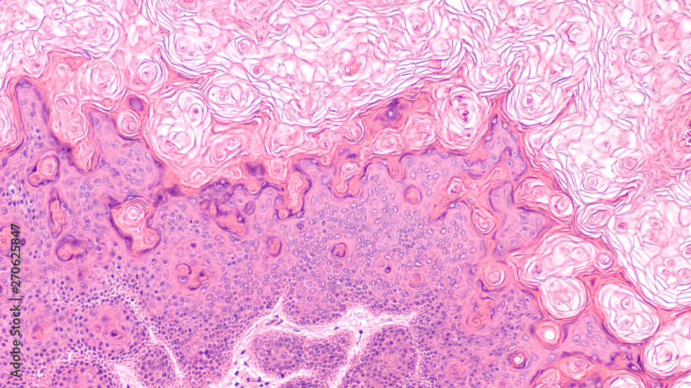 Microscopic image of a proliferating epidermoid cyst, a type of ...