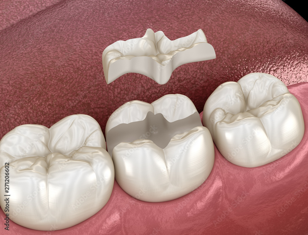 Inlay ceramic crown fixation over tooth. Medically accurate 3D ...