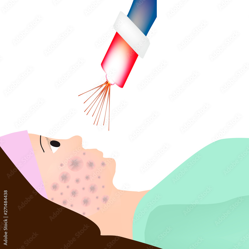 Skin scars after acne and pimples. Treatment of scars on the skin of ...