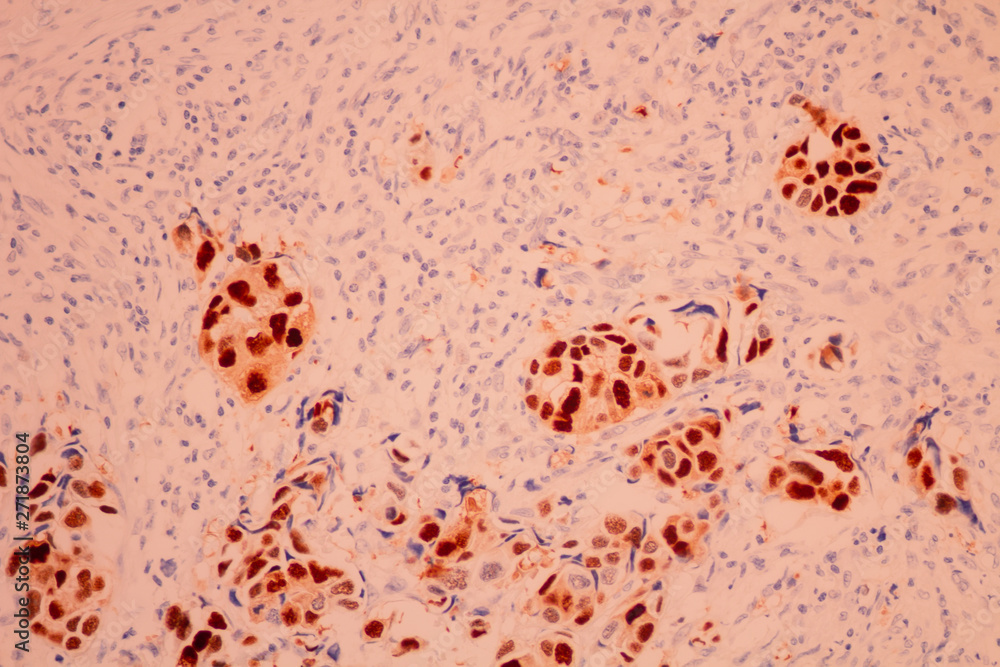 View in microscopic of pathology cross section tissue ductal cell ...