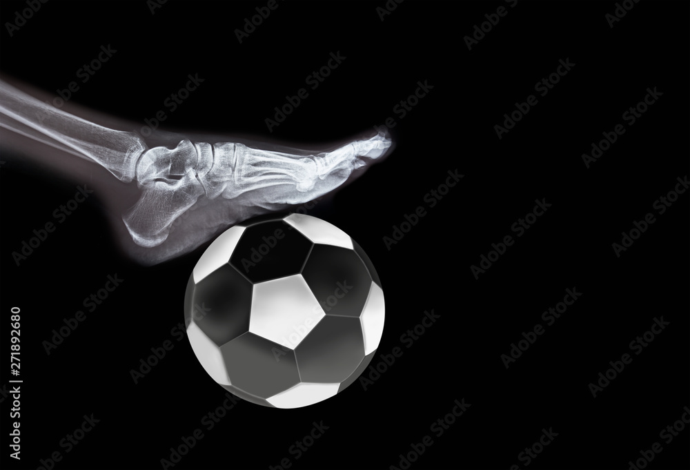 Soccer player's health concept - X-ray normal human's foot with soccer ...
