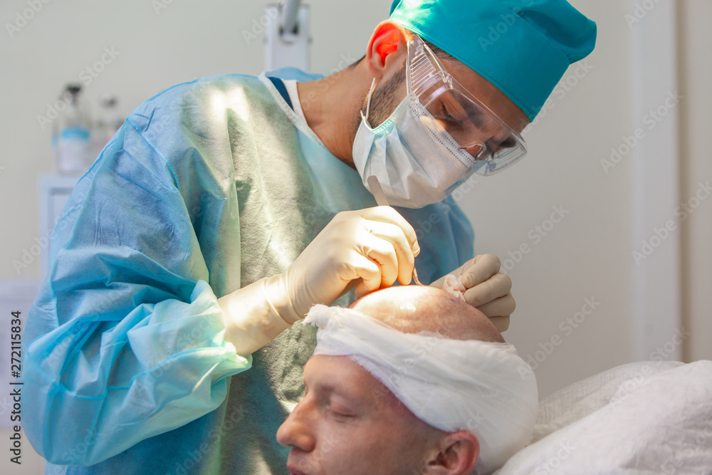 Foto de Stock Baldness treatment. Hair transplant. Surgeons in the ...