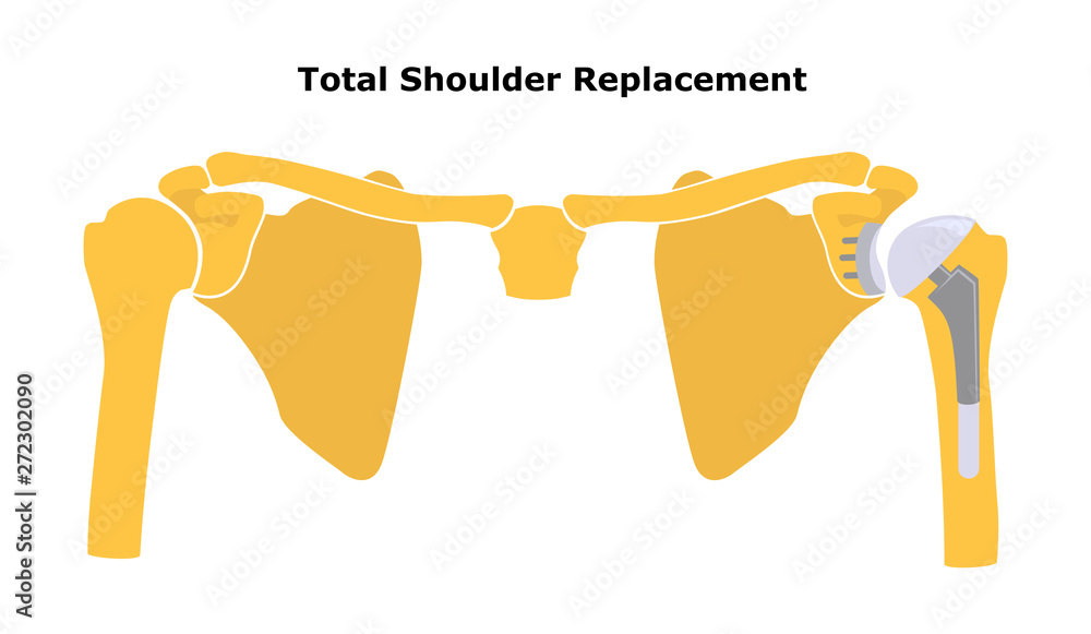 Total Shoulder Replacement. Shoulder joint replacement, endoprosthetics ...