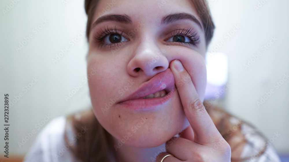 Young woman with a sore lip. Aphthous stomatitis is a common condition ...