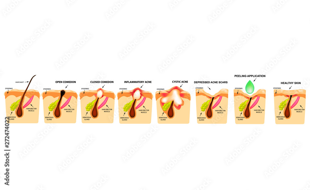 Treatment of open comedones, inflamed acne, acne cysts. Sore acne. The ...