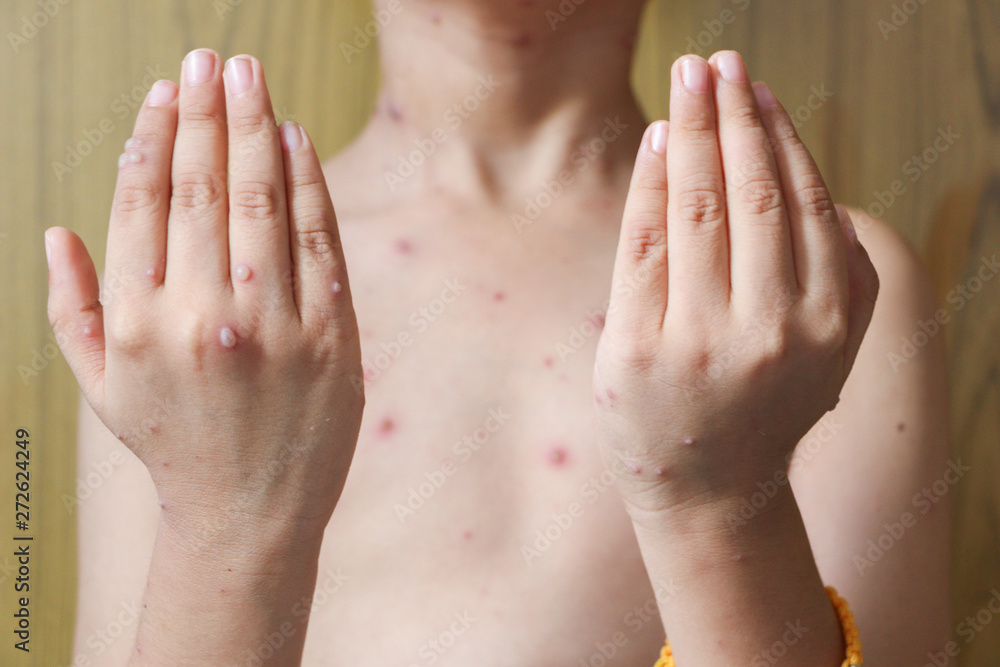 Chicken pox rash on young boy body.Chickenpox is an infection caused by ...