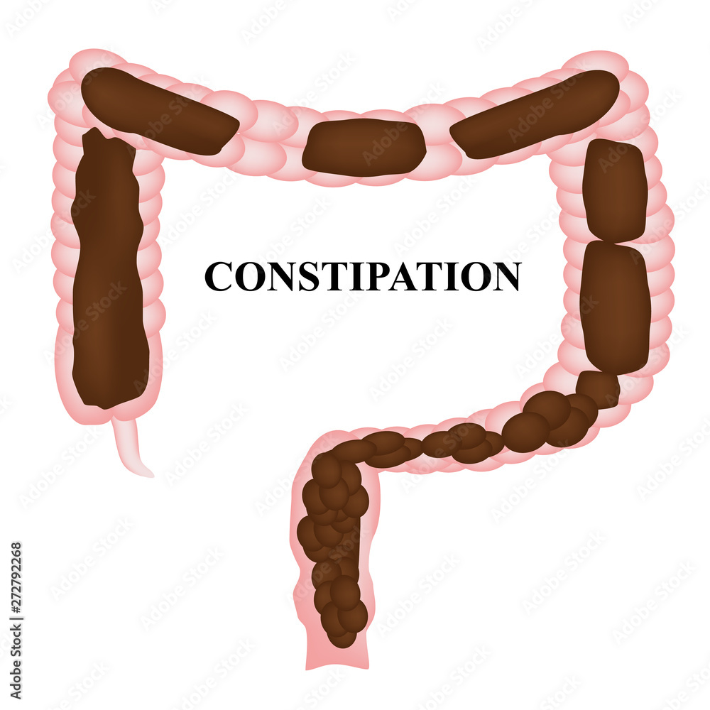 Constipation. Feces in colon. Infographics. Vector illustration on ...