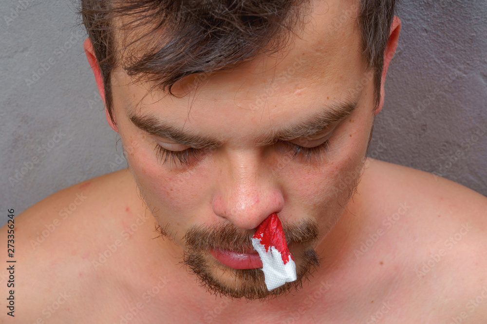 Bleeding from the nose of a young guy. Blood pressure in men. White ...